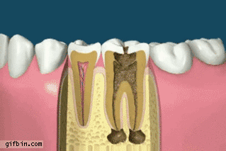 Root Canal Treatment And Dental Crown | Best Funny Gifs Updated Daily
